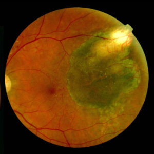 Melanoma de coroides - Cemesur Vision 21 Medicos con experiencia